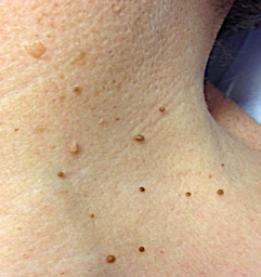 Advanced Electrolysis for Milia & Skin Tags | Health and Beauty in Balance